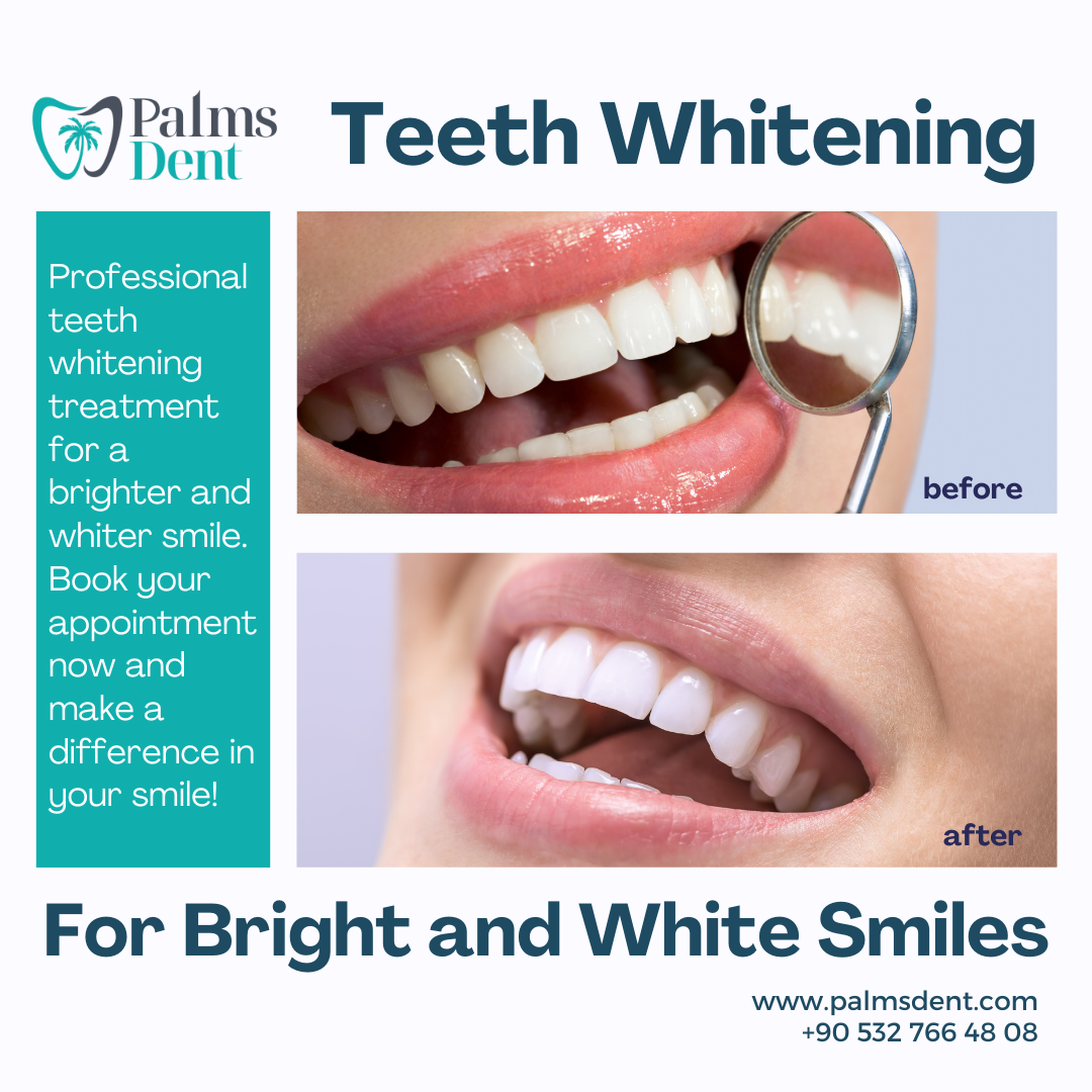 Teeth Whitening in Fethiye: Transform Your Smile at Palms Dent - Palms Dent